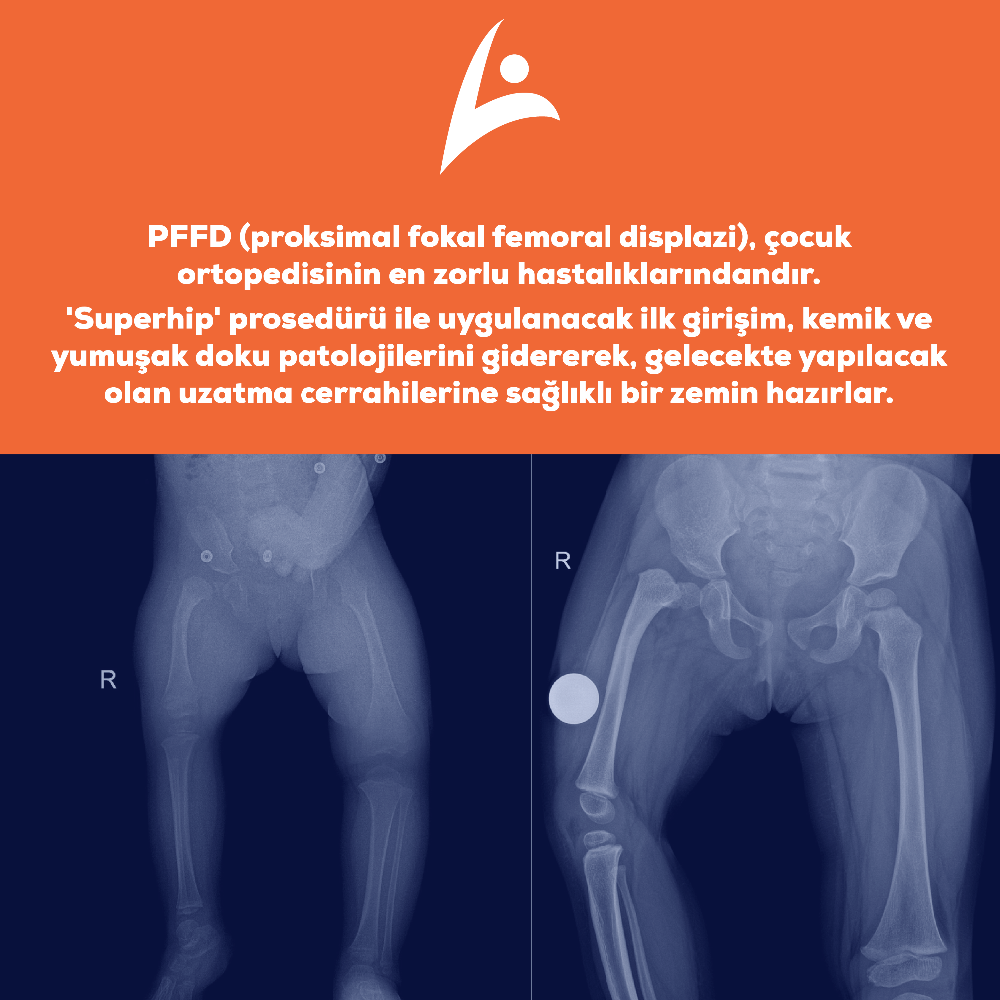 Prof. Dr. Levent ERALP / PFFD (proksimal fokal femoral displazi), çocuk ...